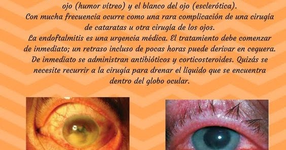 Clínica de Ojos Oftalmic Láser: ENDOFTALMITIS