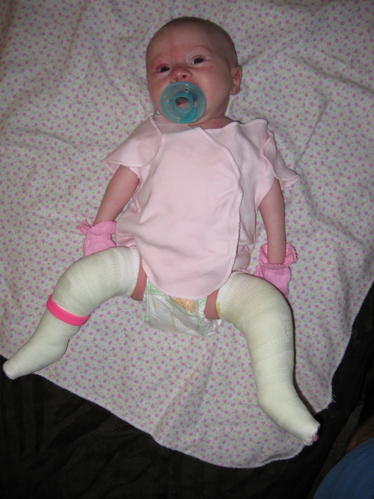 Sweet Analise Rose's Journey with Arthrogryposis, Amyoplasia type: Day ...