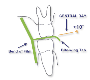Dentistry and Medicine: Intraoral Radiographic Techniques (Bitewing ...