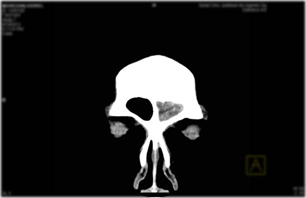 Pansinusitis on the left side - CT Scan