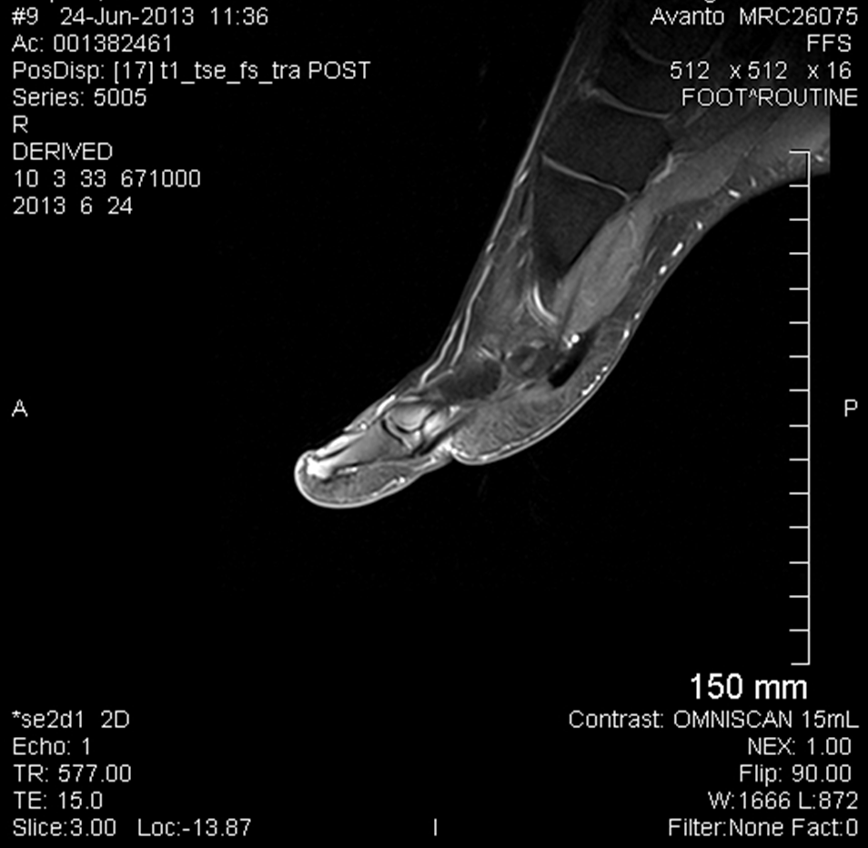 wtf is wrong with my toe???: Toe MRI