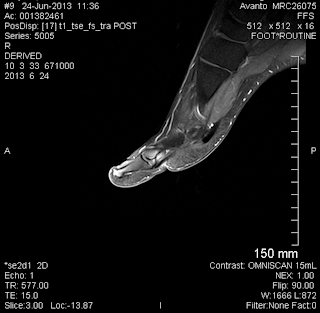 wtf is wrong with my toe???: Toe MRI