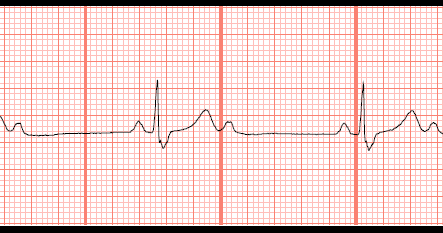 Heart Block Quiz 299