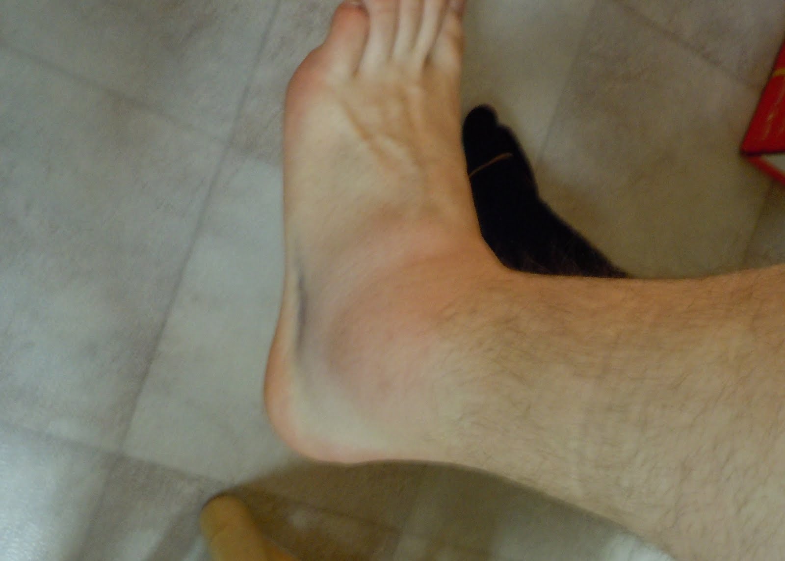 Tyler in Arizona: April 4- Sprained Ankle from March Ultimate Frisbee