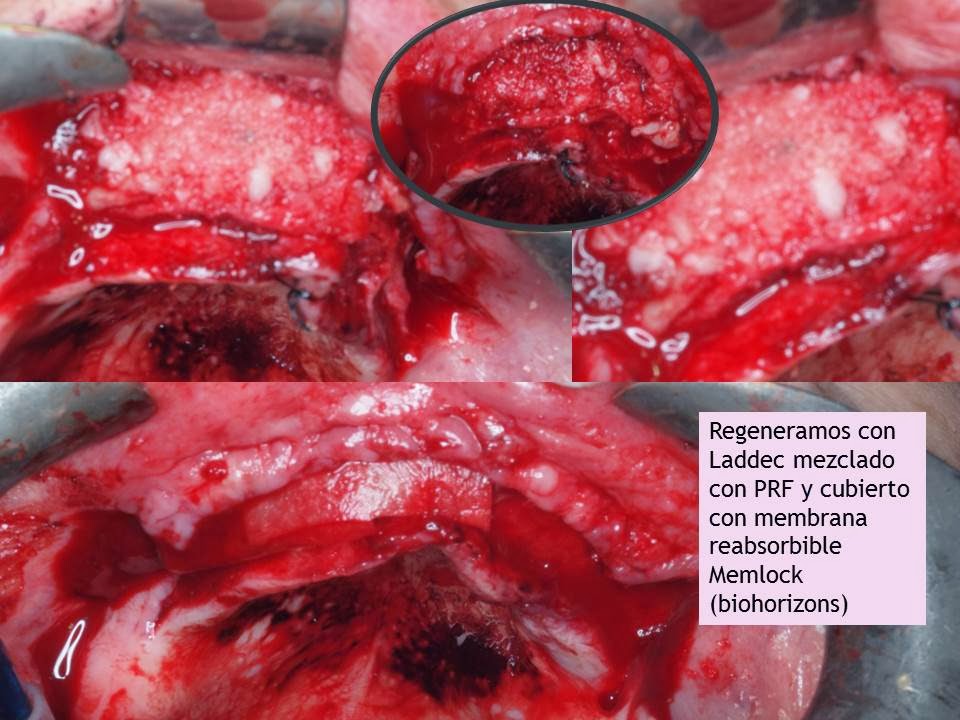 Escuela Implantológica Campos Clinicae: Injerto en Bloque Autólogo