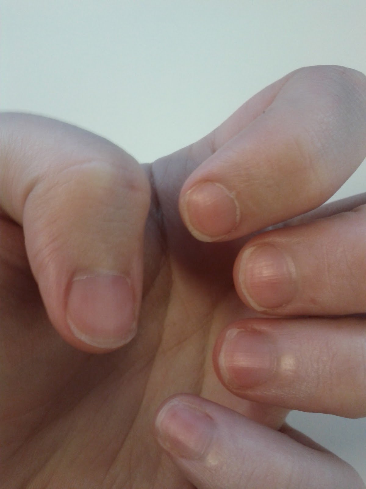 My Troublesome Nails