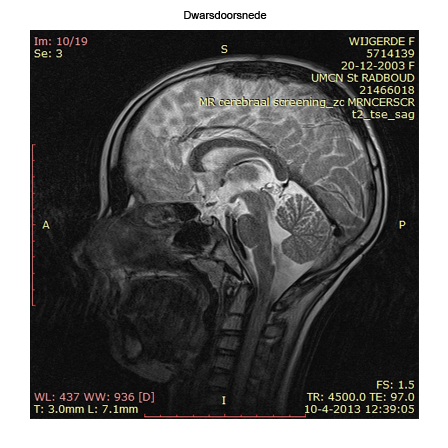 Femke en Moyamoya: MRI en MRI MRA beelden Femke