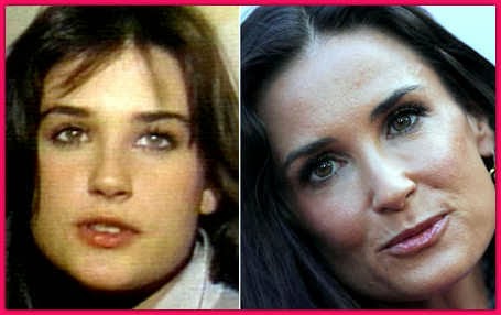 Demi Moore Admits Plastic Surgery Before and After Pictures Botox ...