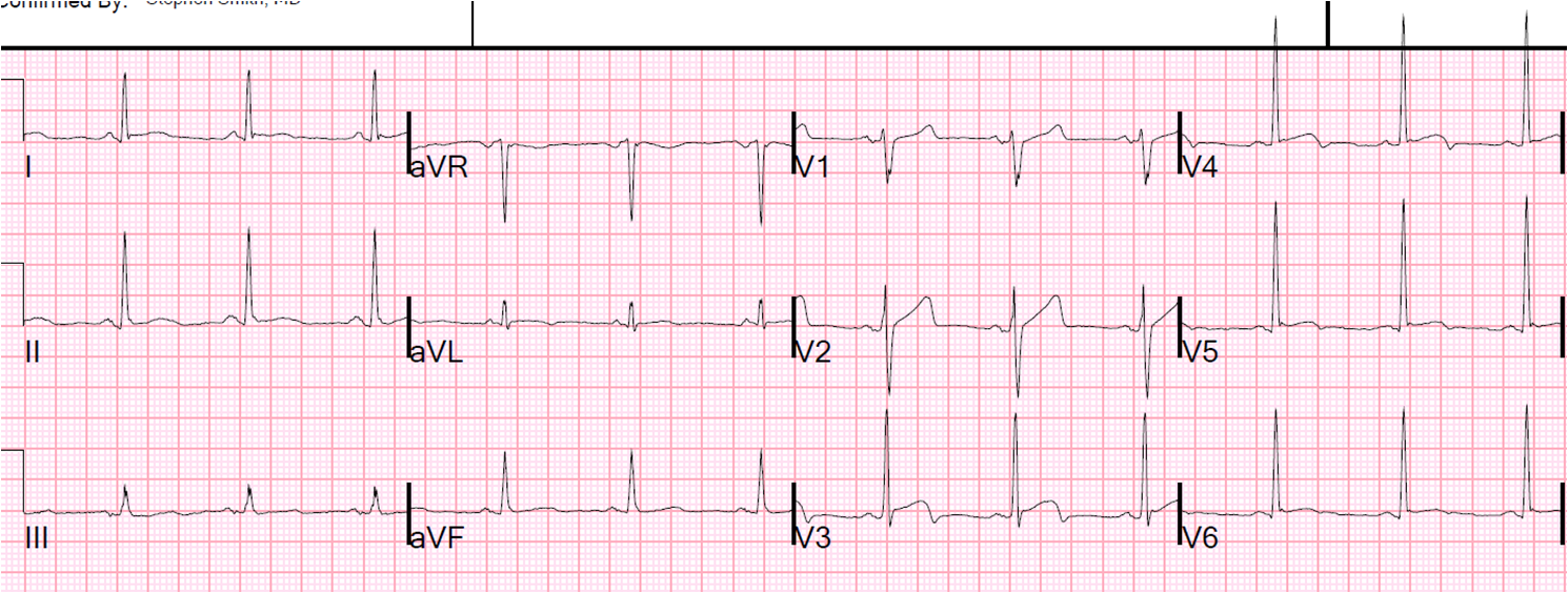 Dr. Smith's ECG Blog: Is it Wellens' Syndrome?