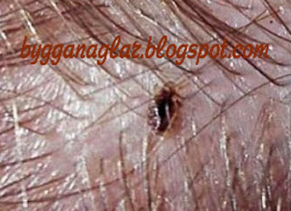 Bygga naglar.Hår.Nails: Huvudlöss bild. Löss bilder. Head lice images.