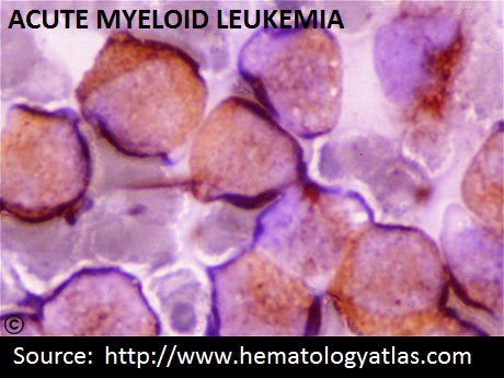 Lab Atlas: Acute Myeloid Leukemia