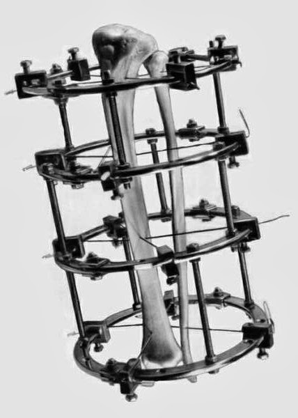 EU E O ILIZAROV SUPERAÇÃO: A HISTORIA DO ILIZAROV