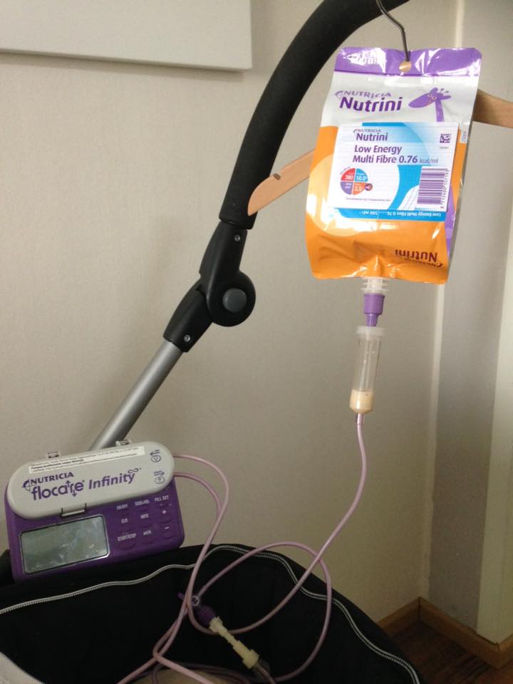 Ainutlaatuinen Amanda: Amandan ruokailu ja PEG