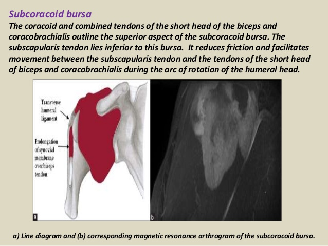 MRI Musculo-Skeletal Section: Bursa of shoulder.