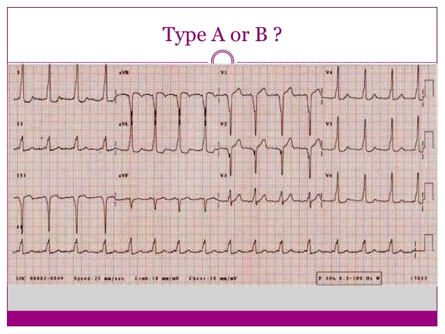 Cardiology Lab: Accessory pathways (AP)
