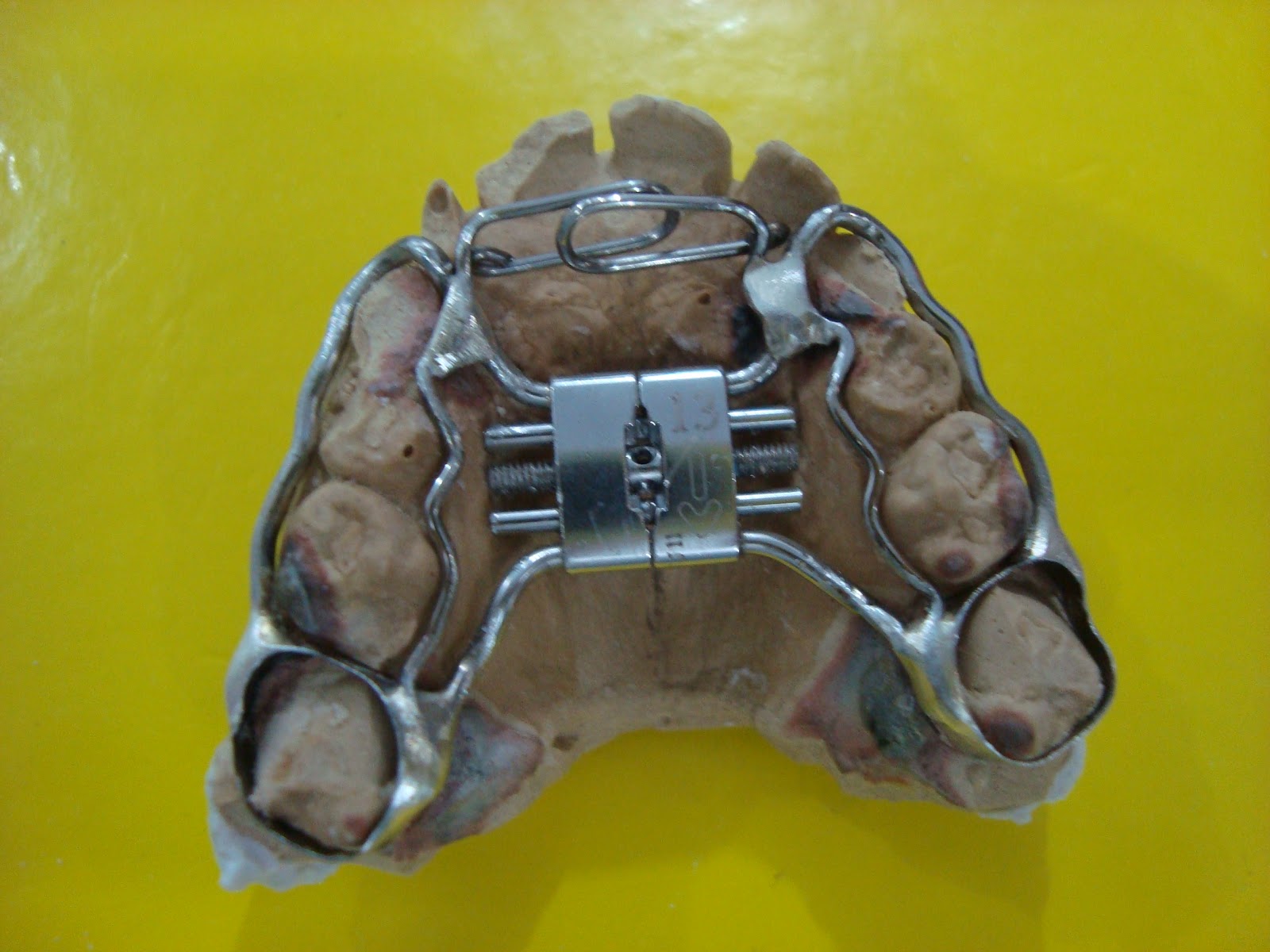 Laboratório Ortodôntico Bohrer: CONFECÇÃO DE HYRAX