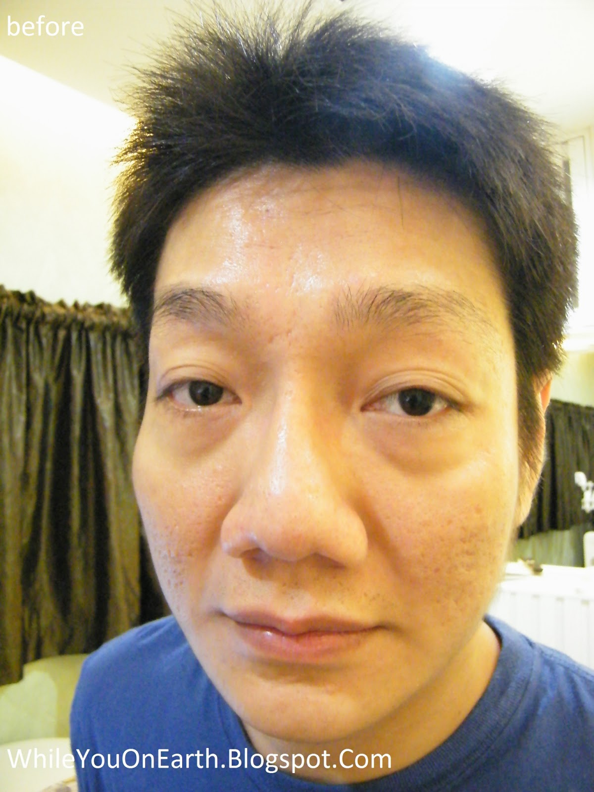 While you on earth..: ZAP Eye Treatment