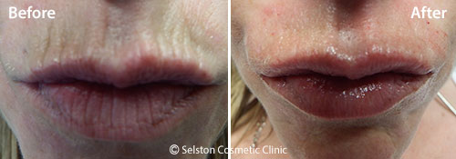 Selston Cosmetic Clinic: Healthy Lips, Lip Lines & Creases and Dermal ...