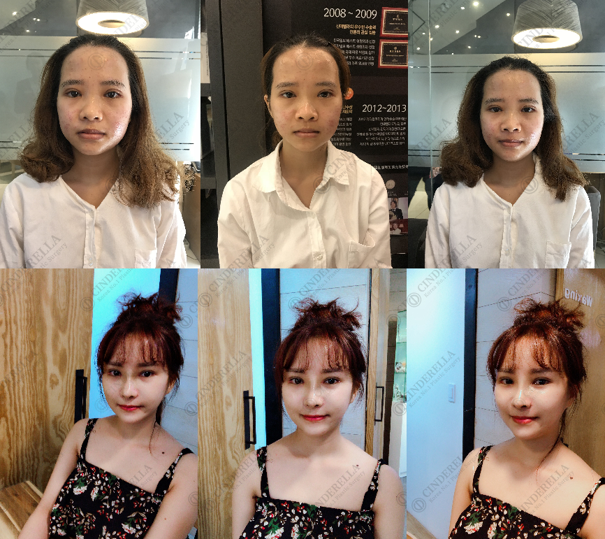 Cinderella Plastic Surgery: Cam's Real Story!