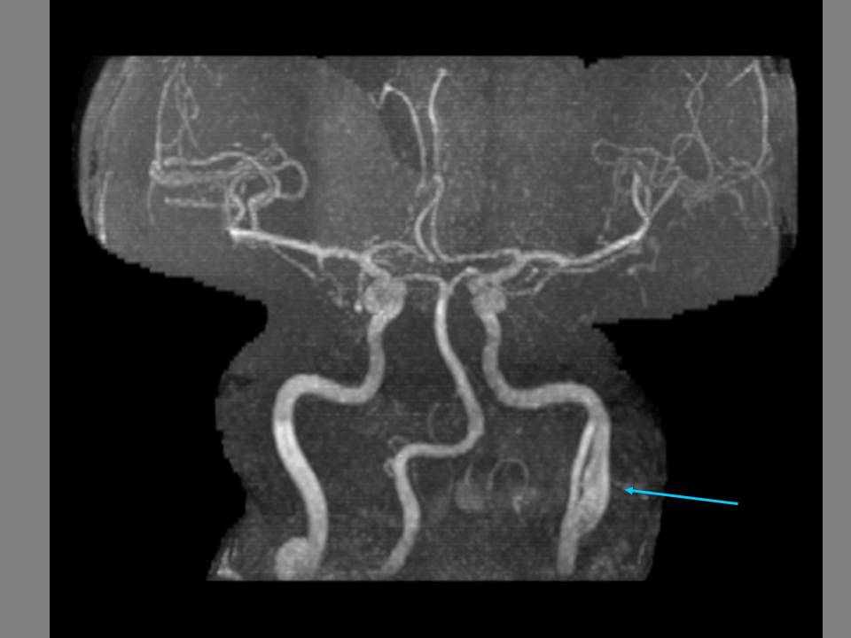 The Pump and the Tubes: Carotid Dissection on MRA