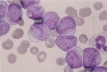Células importantes en hematología: LEUCEMIA MIELOIDE AGUDA M0 ...