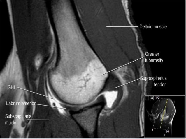 MRI Musculo-Skeletal Section: MRI anatomy of the shoulder (ABER view).