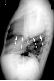 Chest Medicine Made Easy-Dr Deepu: signs in chest radiology Bulging ...