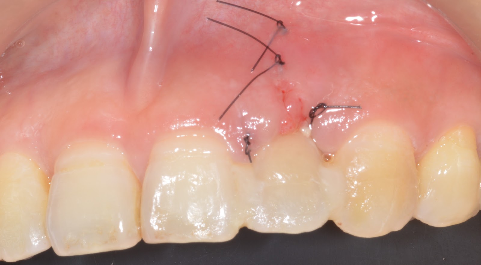 Carl Conley: Ridge Preservation w Bone graft / CT graft / + Socket Seal ...