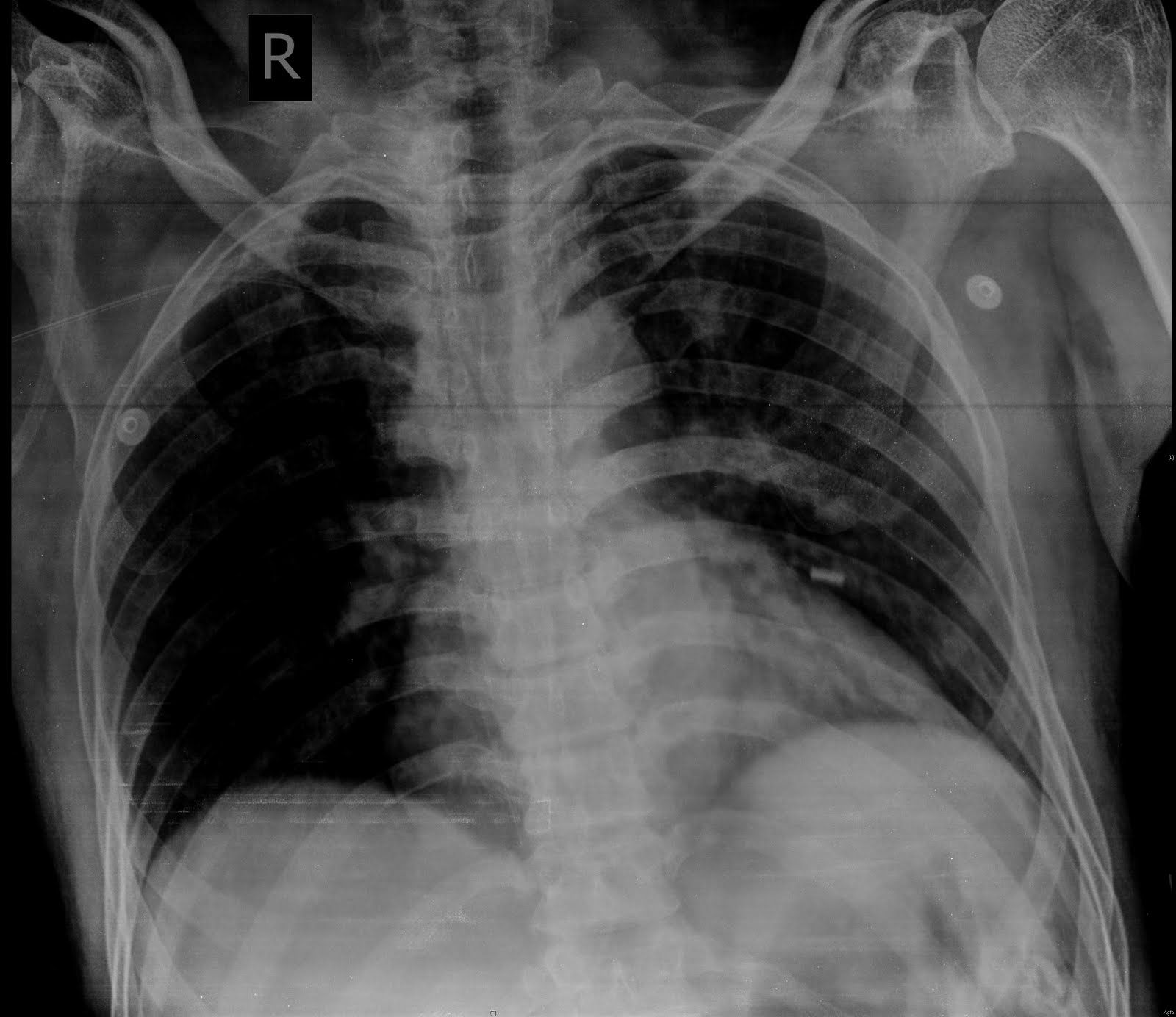 Malpositioned Ryles Tube into Left Bronchus - Sumer's Radiology Blog