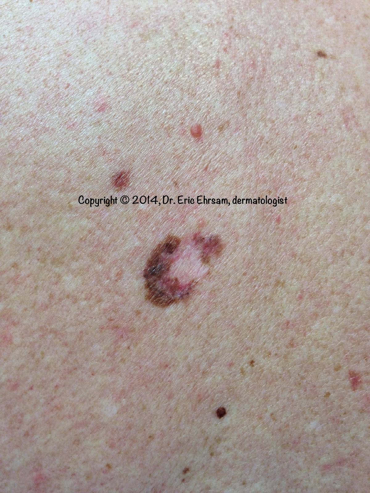 dermoscopy: Regression