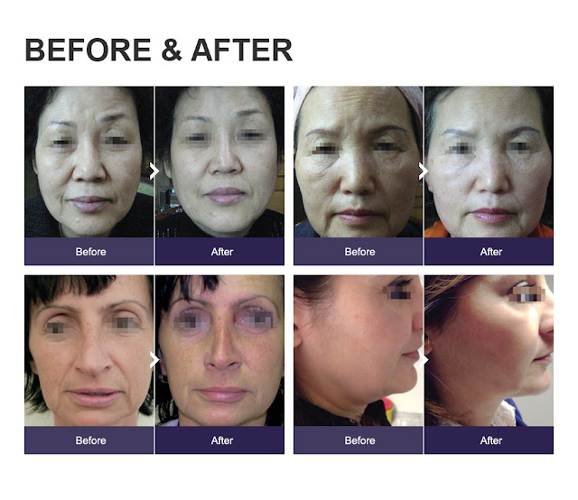 Renewme Skin Clinic: Shurink (Ultraformer 3) HIFU for Non-Invasive Lifting