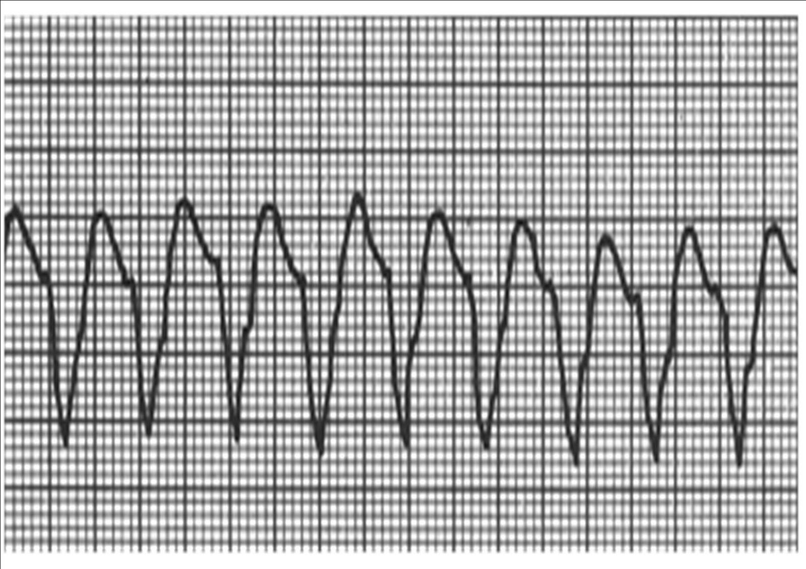 c@rdiaC lOVer: Bagaimana Mekanisme Terjadinya Henti Jantung (Cardiac ...