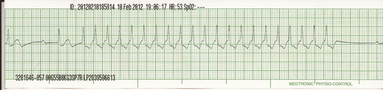 Float Nurse: EKG Rhythm Strip Quiz 1