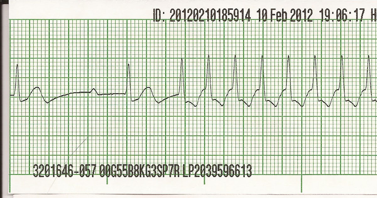 EKG Rhythm Strip Quiz 1