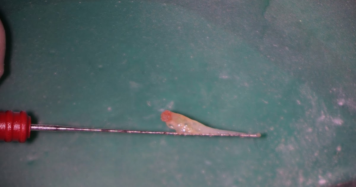 The Endo Blog: Pulpal Tissue