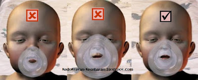 Ventilasi Tekanan Positif / VTP pada Resusitasi Bayi atau Neonatus ...