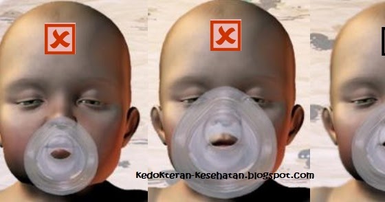 Ventilasi Tekanan Positif / VTP pada Resusitasi Bayi atau Neonatus ...