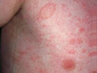 Information contact dermatitis skin complaint | Share All Knowledge