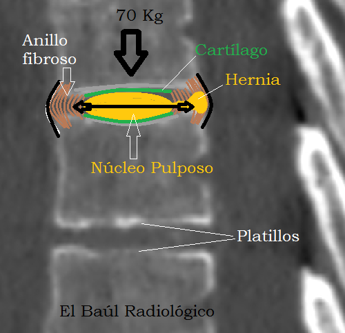 El Baúl Radiológico: ENFERMEDAD DE SCHEUERMANN (DORSALGIA JUVENIL ...