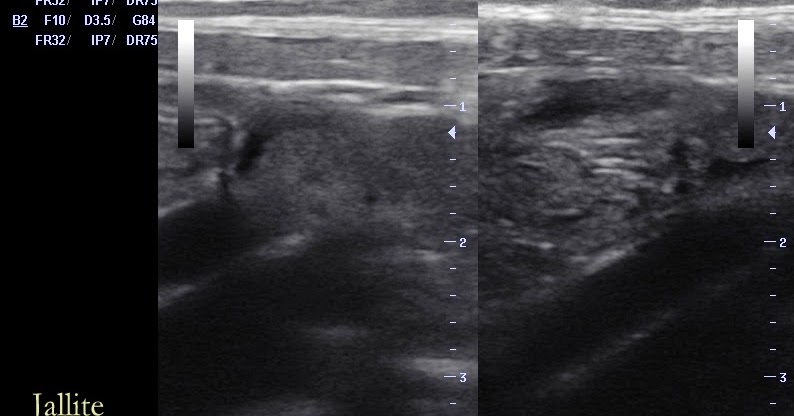 Absceso Post Apendicectomia
