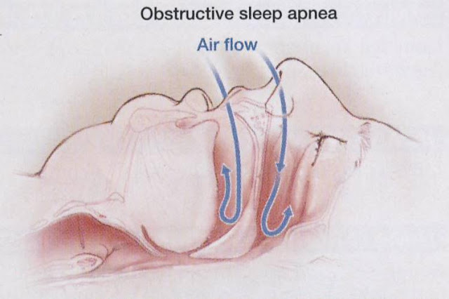 Sleep and Neurology: Obstructive Sleep Apnea 101: The Main Facts