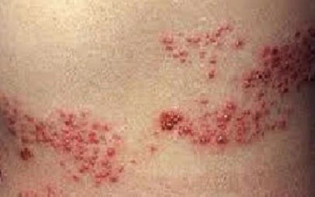 4 Petua Mengubati Penyakit Kayap | Petua dan Tips Seharian Anda