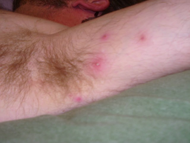 Sporotrichosis