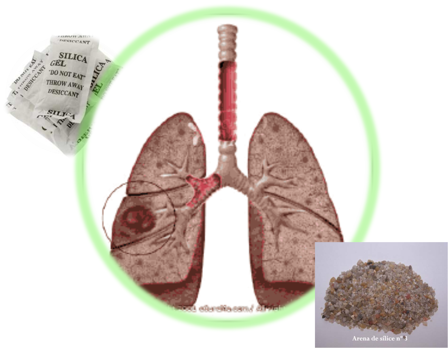silicosis pulmonar: SILICOSIS PULMONAR