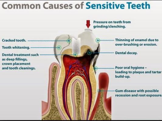DINESH'S DENTAL PARADISE: A sensitive tooth may be due to exposed root ...