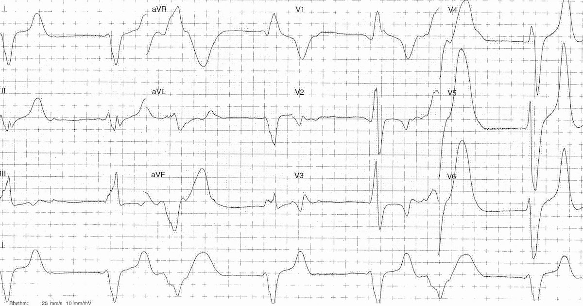 ECG of the Week: ECG of the Week - 20th March 2017 - Interpretation