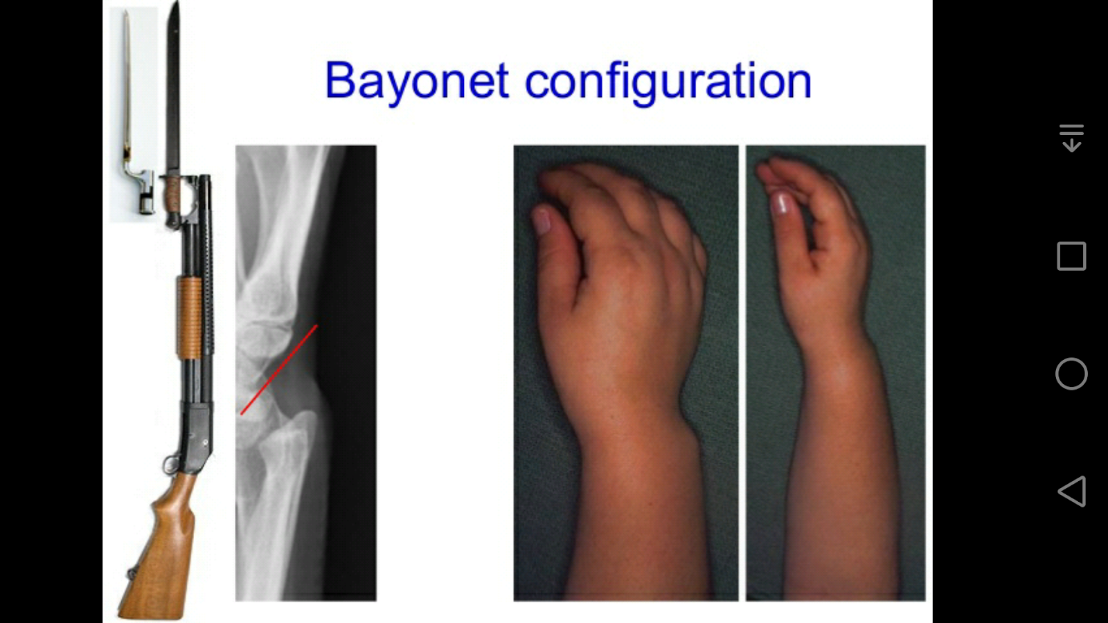 Spot diagnosis? Identify the deformity at wrist ? Madelung deformity