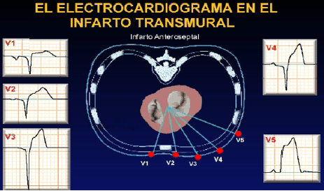 Electrocardiograma infarto transmural anteroseptal