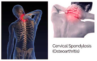 Cervical Osteoarthritis