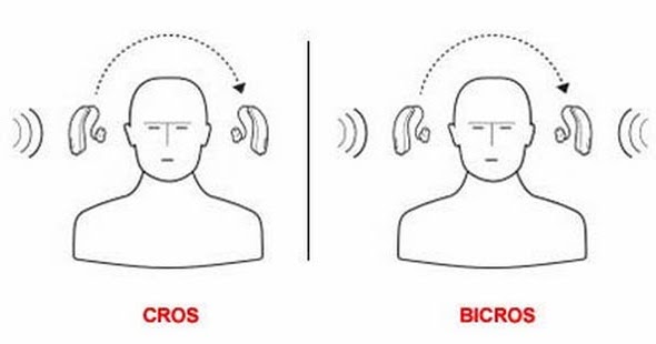 Cros Hearing Aid : Cros Hearing Aid Pros And Cons